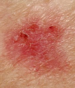 Skin Cancer Treatment & Care | Expert Dermatologists at The Skin Centre