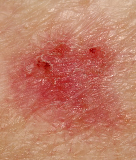 Skin Cancer Treatment & Care | Expert Dermatologists at The Skin Centre