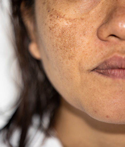 Pigmentation Treatments | Skin Specialist Australia