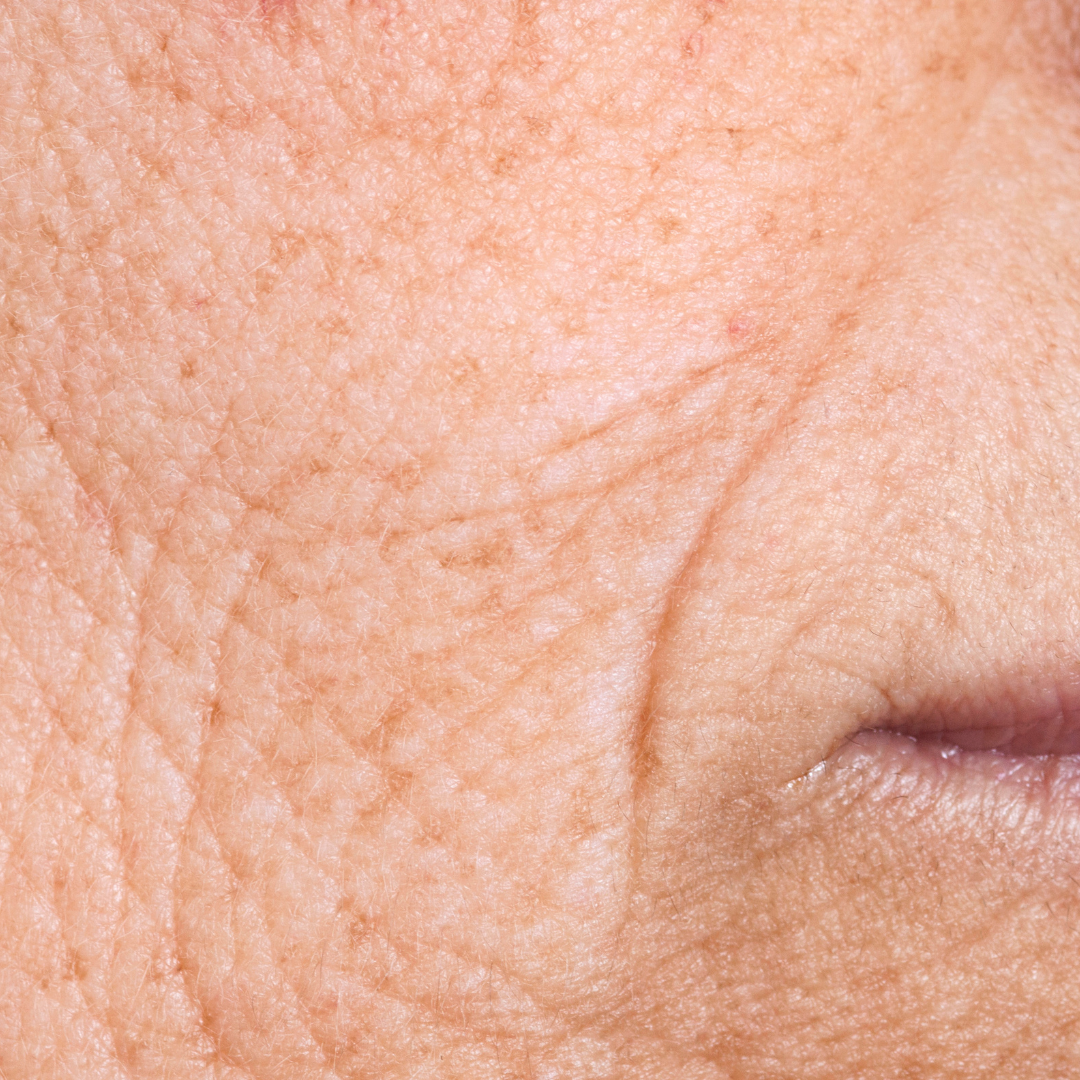 Is Laser Genesis Right for You? A Complete Guide